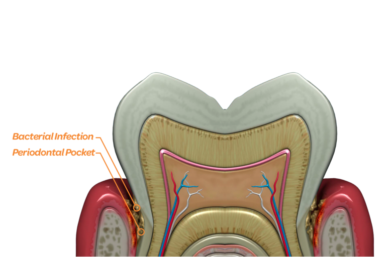 How It Works - Perio Protect